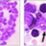 Acute Myelomonocytic Leukemia Subtypes M4 and M5