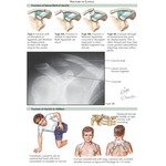 Fractures of the Clavicle