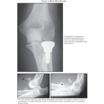 Imaging of Radial Head Fractures