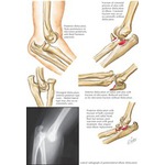 Dislocation of Elbow Joint