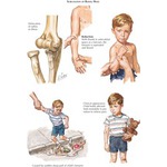 Subluxation of Radial Head