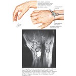 Ganglion of Wrist