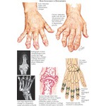 Hand Involvement in Osteoarthritis