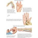 Trigger Finger and Jersey Finger