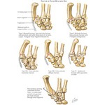 Fracture of Thumb Metacarpal Base