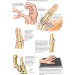 Thumb Ligament Injury and Dislocation