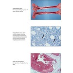Polycythemia Vera