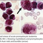 Acute Myelogenous Leukemia Subtype M3