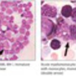 Acute Myelomonocytic Leukemia Subtypes M4 and M5