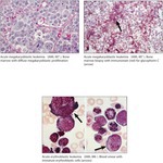 Acute Myelogenous Leukemia Subtypes M7 and M6