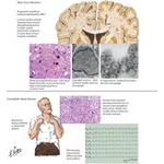Slow Virus Infections and Spongiform Encephalopathies