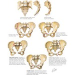 Pelvic Fractures