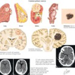 Metastatic Brain Tumors