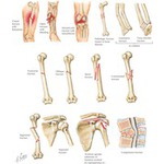 Fractures