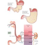 Pyloric Obstruction, Effects of Vomiting