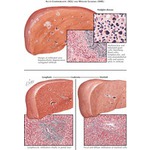 Hematologic Malignancy and the Liver: Hodgkin’s Disease, Leukemia ...