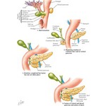 Development of the Gallbladder and Bile Ducts