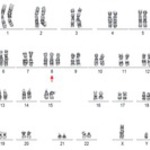 Abnormal karyogram of a bone marrow cell from a patient with acute ...