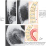 Radiographic Findings in Osteoporosis