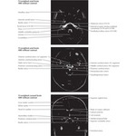 Axial and Coronal MRIs of Brain