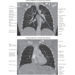 Thorax - Coronal CTs