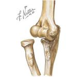 Dislocation and Subluxation of the Radius
