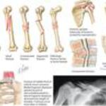 Types of Fracture