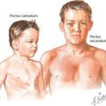 Congenital Deformities of Thoracic Cage