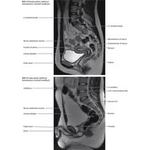Pelvic Scans: Sagittal T2-Weighted MRIs