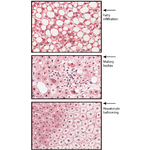 Pathological Findings in Alcohol-associated Steatosis and Steatohepatitis