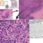 Pathology of Lymphoid System