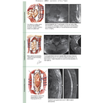 Myelographic and CT Characteristics of Spinal Tumors