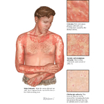 Urticaria