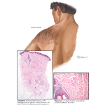Becker's Nevus (Smooth Muscle Hamartoma)