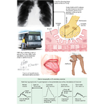 Presynaptic Neuromuscular Junction Transmission Disorders: Lambert-Eaton Myasthenic Syndrome and ...
