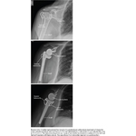 Proximal Humeral Fractures: Reverse Total Shoulder Replacement