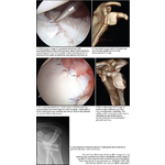 Posterior Dislocation of the Glenohumeral Joint (Continued)