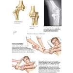 Dislocation of Elbow Joint (Continued)