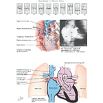 Anomalies of the Tricuspid Valve