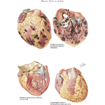Metastatic Heart Tumors