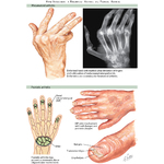 Hand Involvement in Rheumatoid Arthritis and Psoriatic Arthritis