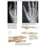 Ligament Replacement and Tendon Interposition Arthroplasty for ...