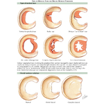 Types of Meniscal Tears and Discoid Meniscus Variations