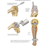 Total Knee Replacement Technique: Steps 6 to 9